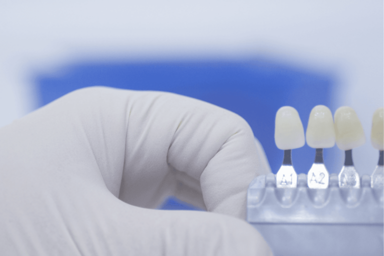 Dean Dental Solutions Custom Shade Match for Crowns